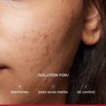 10% Niacinamide Spot Correcting Serum for Acne Marks & Oil Control
