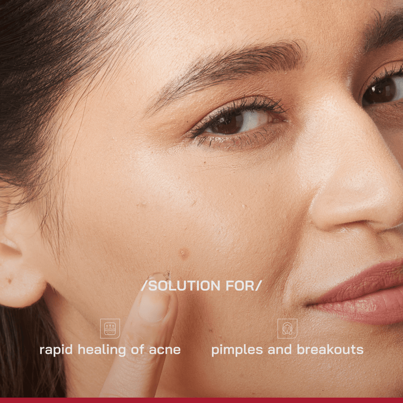 Salicylic Acid Acne Spot Treatment Gel
